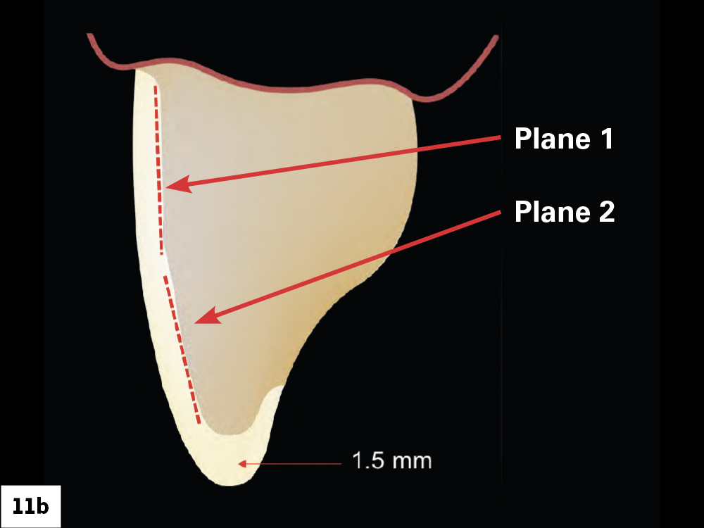 Veneer Preparation and Temporization: Tips and Techniques