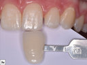Veneer Preparation and Temporization: Tips and Techniques