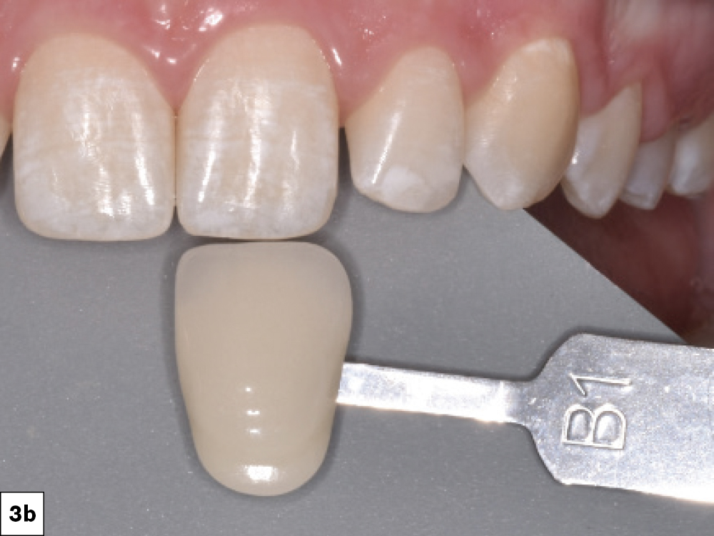Veneer Preparation and Temporization: Tips and Techniques