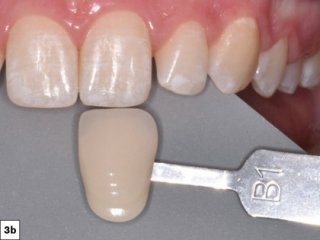 Veneer Preparation and Temporization: Tips and Techniques