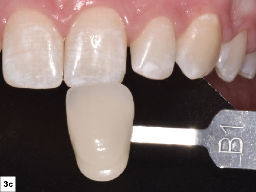 Veneer Preparation and Temporization: Tips and Techniques