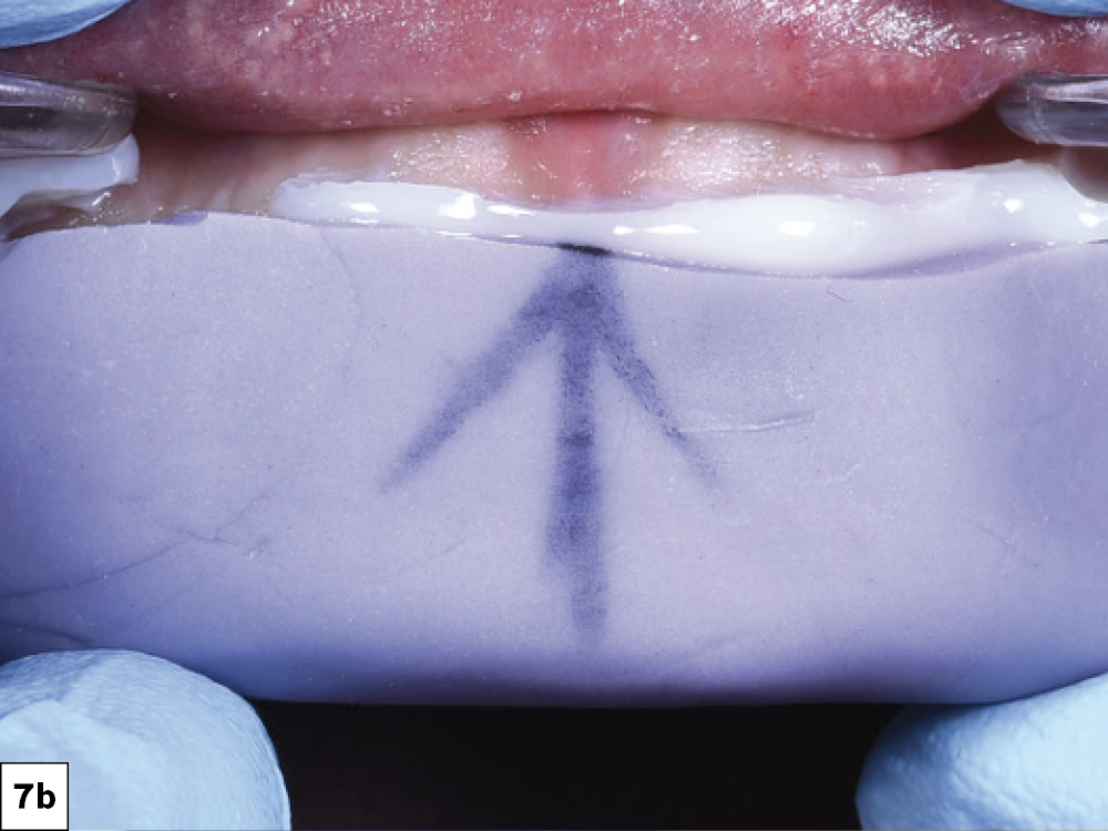 Veneer Preparation and Temporization: Tips and Techniques