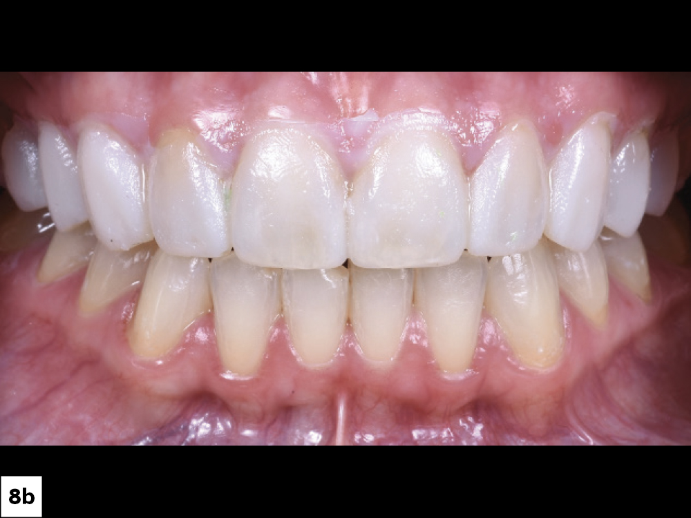 Veneer Preparation and Temporization: Tips and Techniques