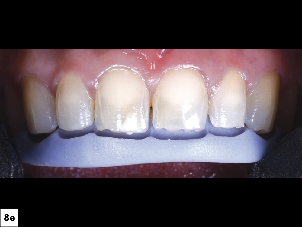 Veneer Preparation and Temporization: Tips and Techniques