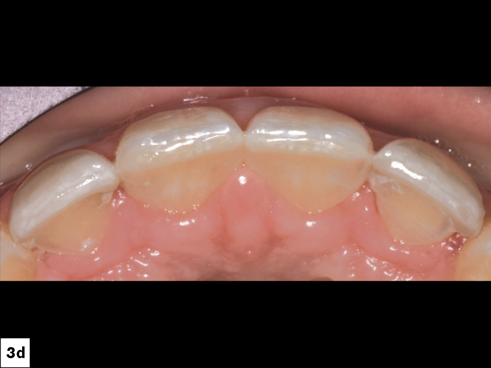 Veneer Preparation and Temporization: Tips and Techniques