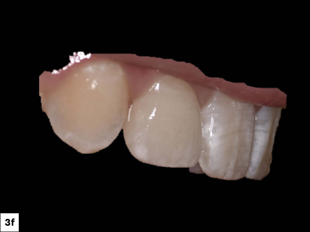 Veneer Preparation and Temporization: Tips and Techniques
