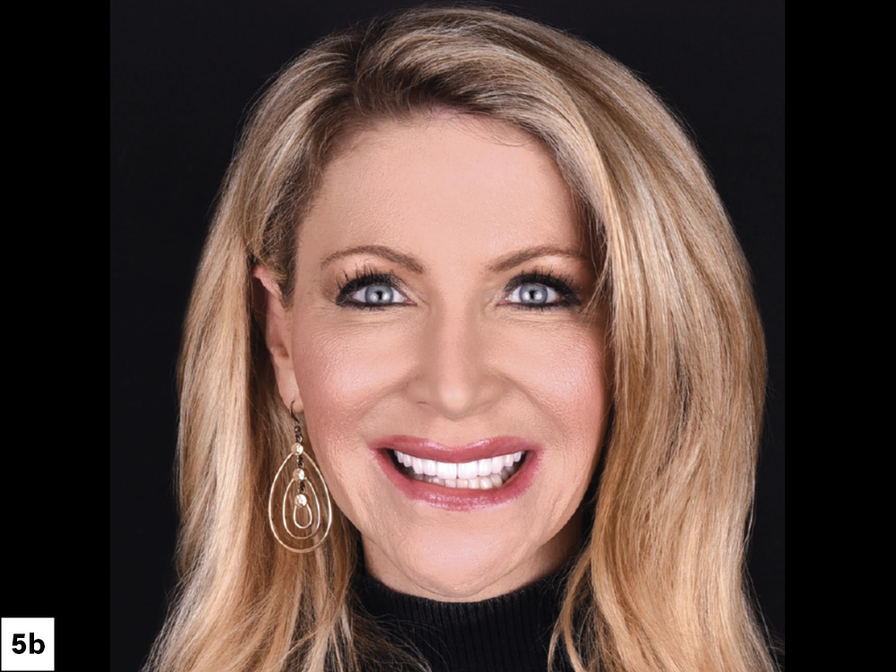 Veneer Preparation and Temporization: Tips and Techniques