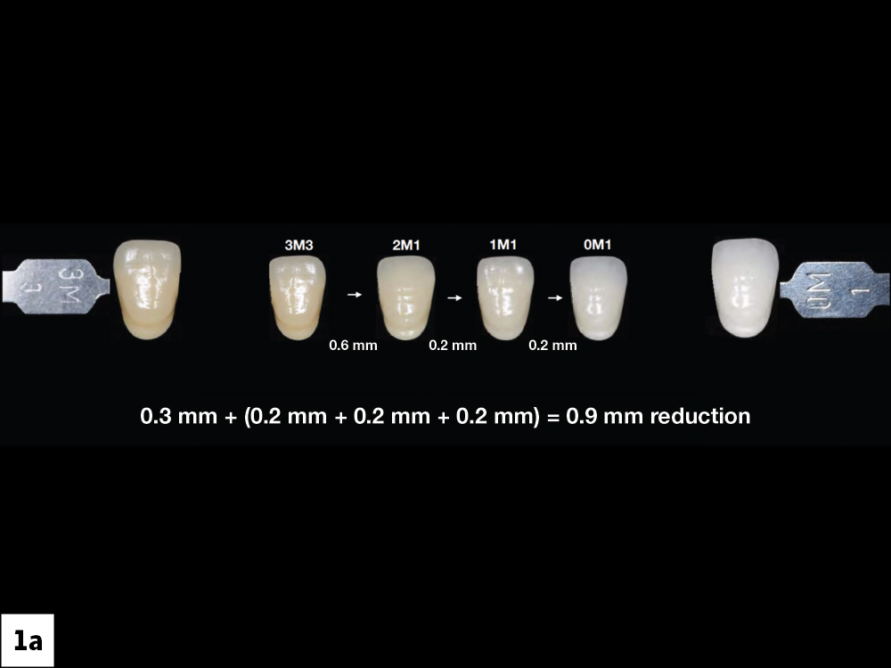 Veneer Preparation and Temporization: Tips and Techniques