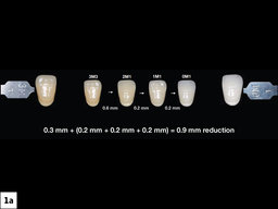 Veneer Preparation and Temporization: Tips and Techniques