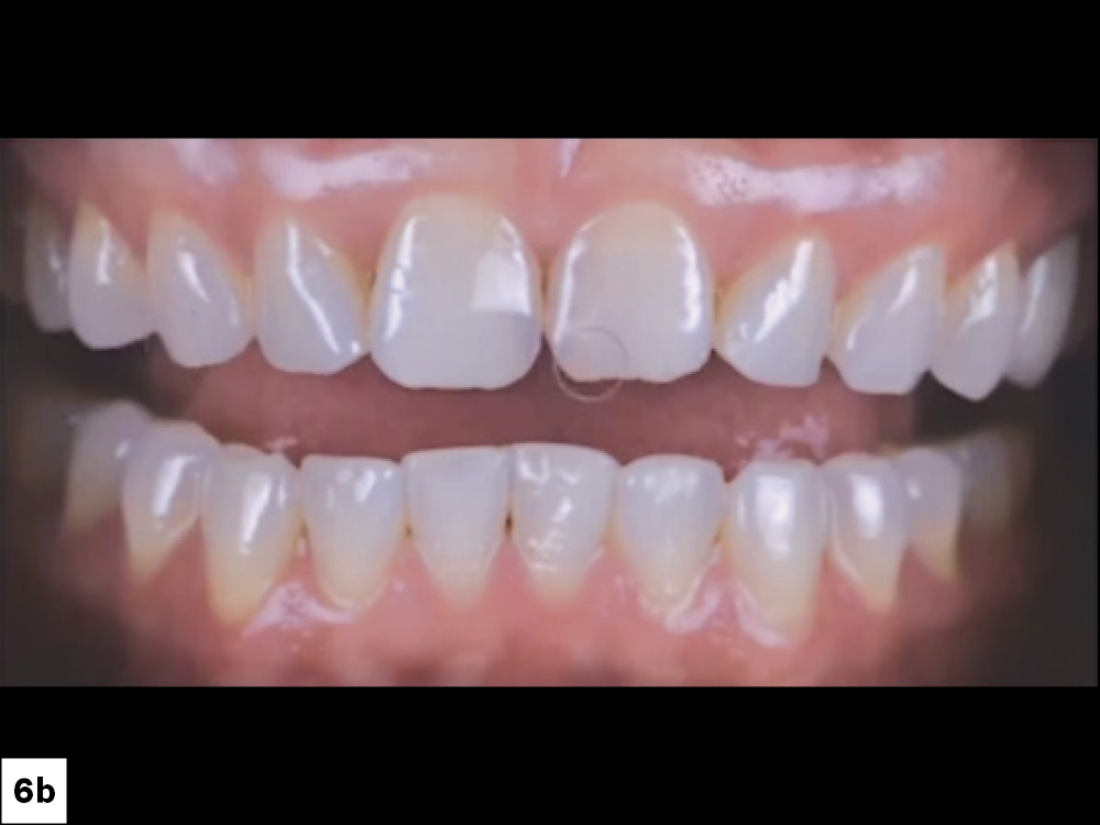 Veneer Preparation and Temporization: Tips and Techniques