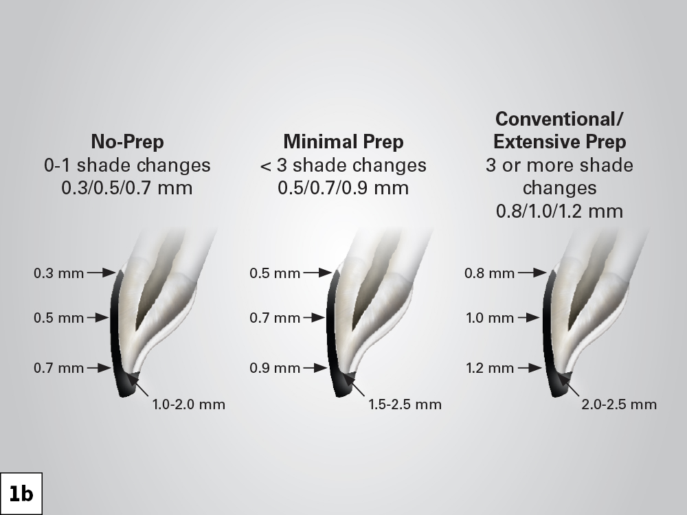 Veneer Preparation and Temporization: Tips and Techniques