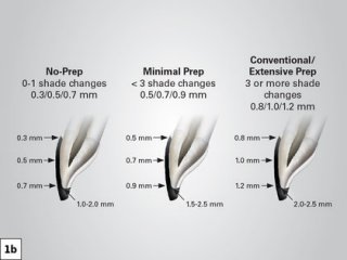 Veneer Preparation and Temporization: Tips and Techniques
