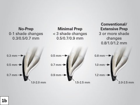 Veneer Preparation and Temporization: Tips and Techniques