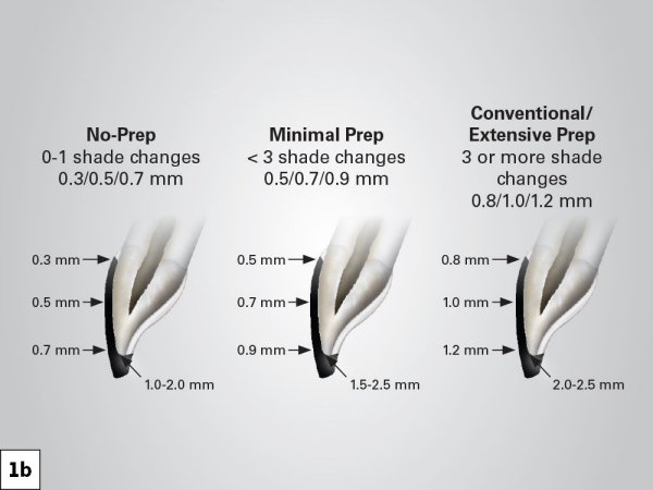 Veneer Preparation and Temporization: Tips and Techniques