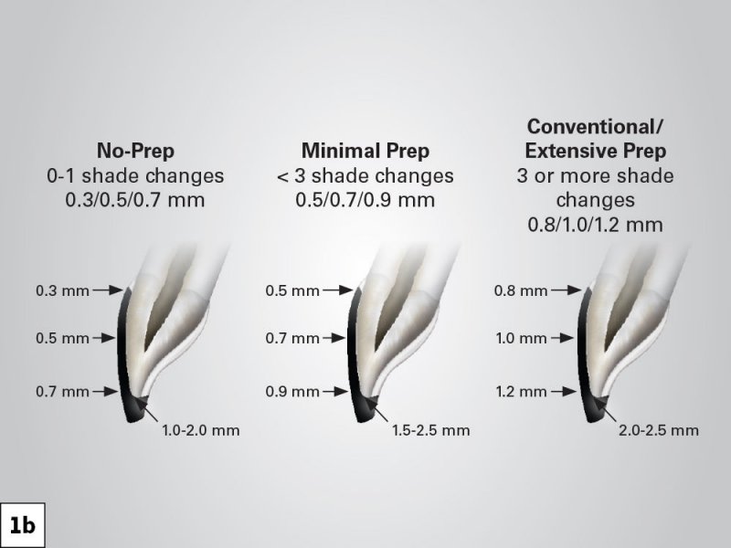 Veneer Preparation and Temporization: Tips and Techniques