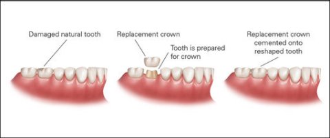 Dental Crowns | Chairside® Magazine | Special Edition