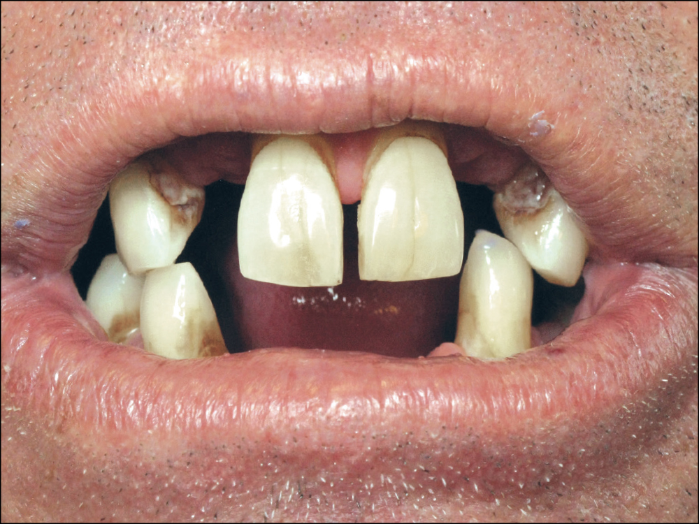 Implant Overdentures Benefits | Chairside® Magazine