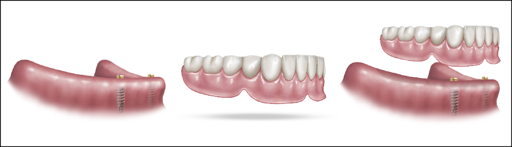 Implant Overdentures Benefits | Chairside® Magazine