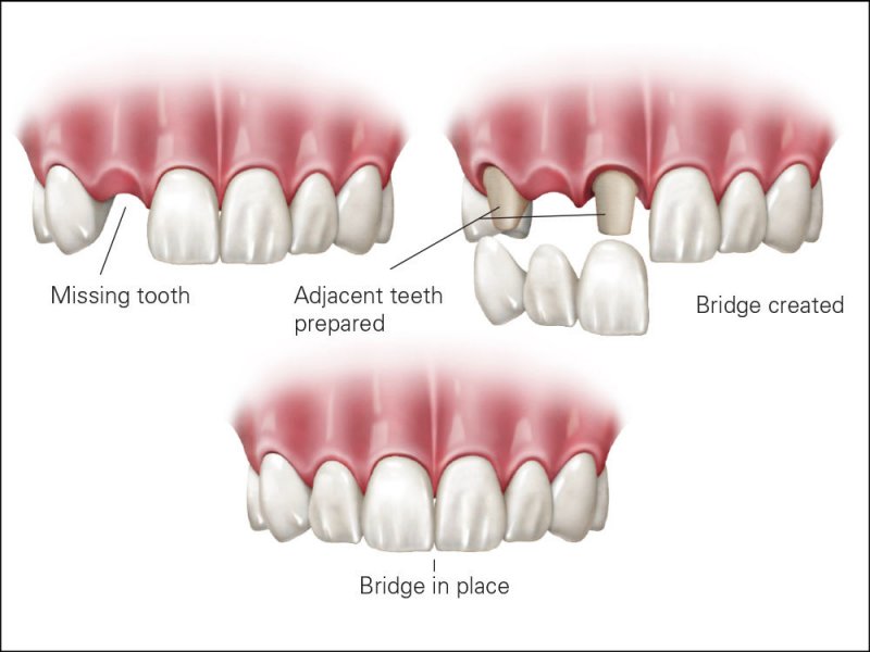 Dental Bridges | Glidewell | Chairside® Dental Magazine