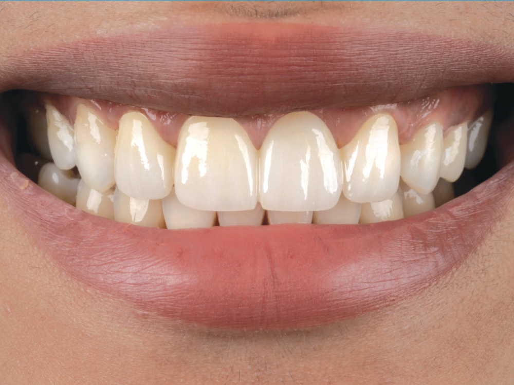 Dental Bridges | Glidewell | Chairside® Dental Magazine