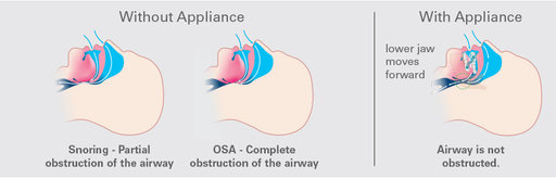 Snoring? Read About Dentist-Prescribed Sleep Appliances