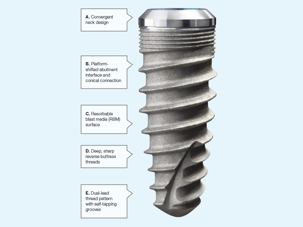 Glidewell HT™ Implant System | Six-Year Study Results