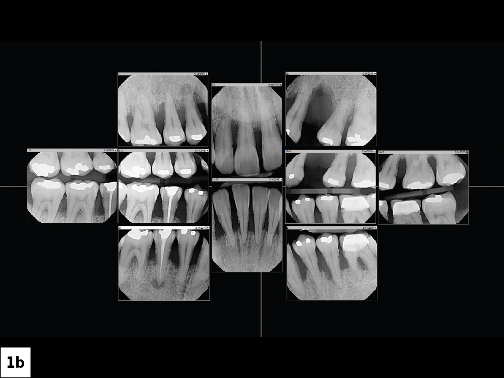 Full-Arch Implant Treatment: A Restorative-Driven Approach