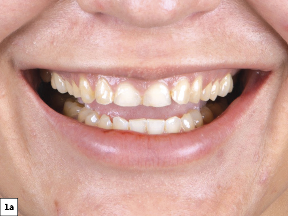 Full-Mouth Esthetic Restorations | The Winning Collaboration