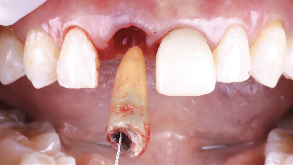 Immediate Placement and Provisionalization in the Anterior