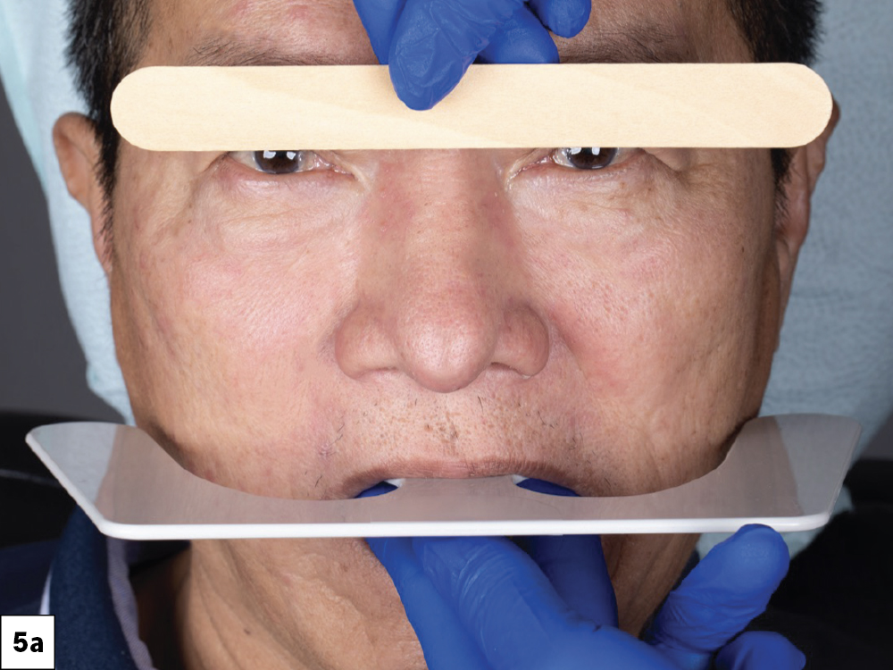 Maxillary Complete Dentures | Full-Arch Rehabilitation