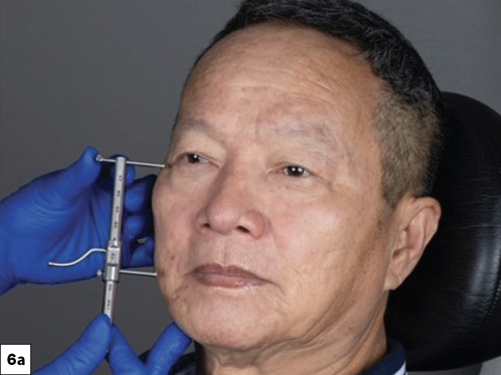 Maxillary Complete Dentures | Full-Arch Rehabilitation