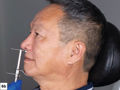 Maxillary Complete Dentures | Full-Arch Rehabilitation