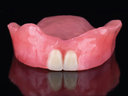 Maxillary Complete Dentures | Full-Arch Rehabilitation