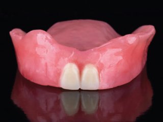 Maxillary Complete Dentures | Full-Arch Rehabilitation