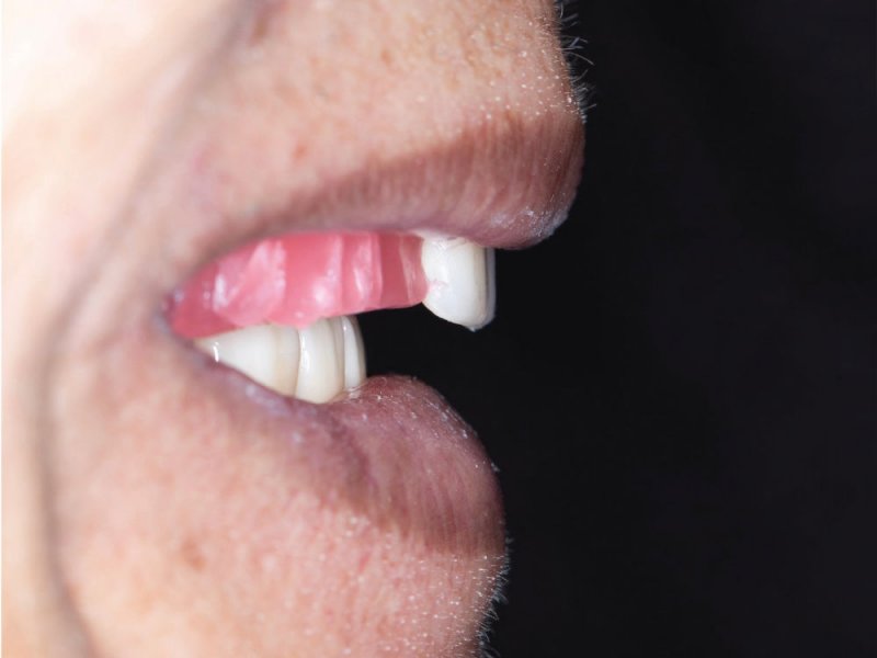 Maxillary Complete Dentures | Full-Arch Rehabilitation