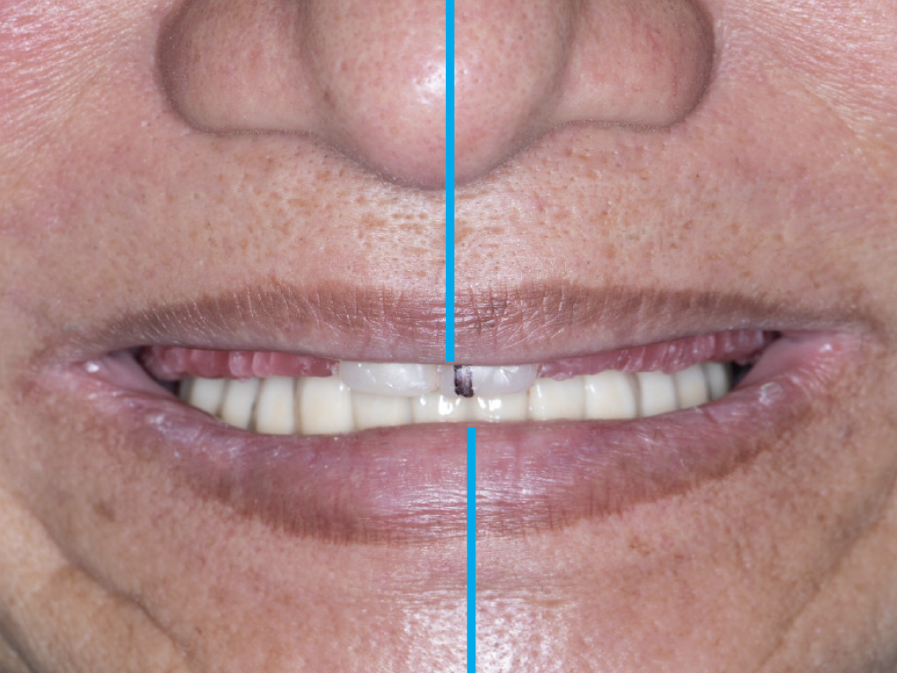 Maxillary Complete Dentures | Full-Arch Rehabilitation