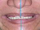 Maxillary Complete Dentures | Full-Arch Rehabilitation