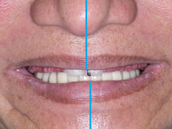 Maxillary Complete Dentures | Full-Arch Rehabilitation