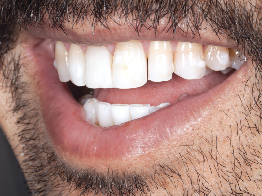 Choosing the Right Retainer for Your Patient