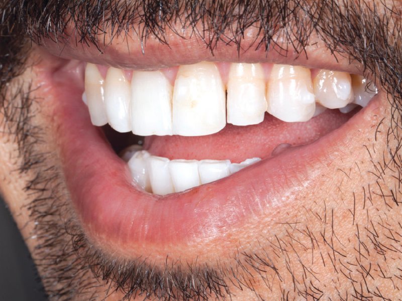 Choosing the Right Retainer for Your Patient