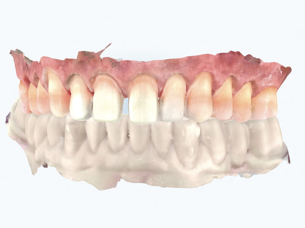 Choosing the Right Retainer for Your Patient