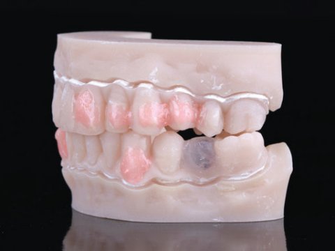 Choosing the Right Retainer for Your Patient
