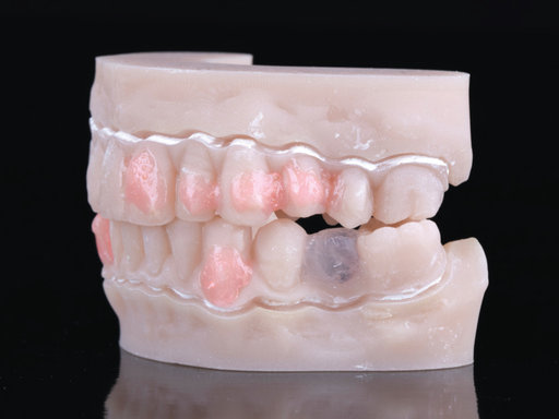 Choosing the Right Retainer for Your Patient