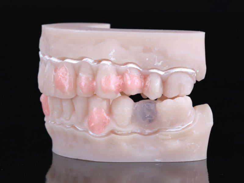 Choosing the Right Retainer for Your Patient