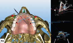 Multi-Level Surgical & Prosthetic Guide