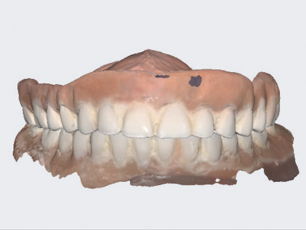 Multi-Level Surgical & Prosthetic Guide