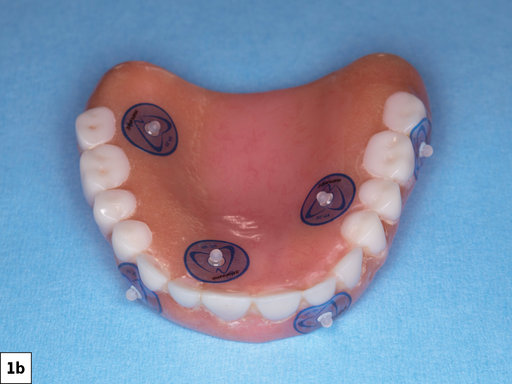 Multi-Level Surgical & Prosthetic Guide