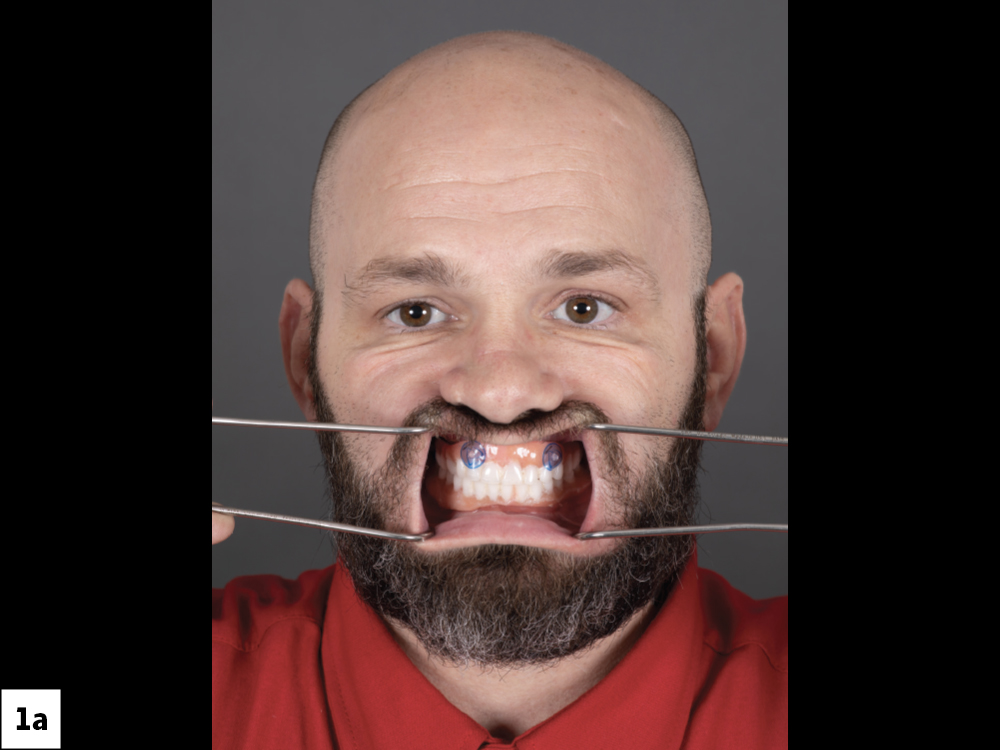 Multi-Level Surgical & Prosthetic Guide