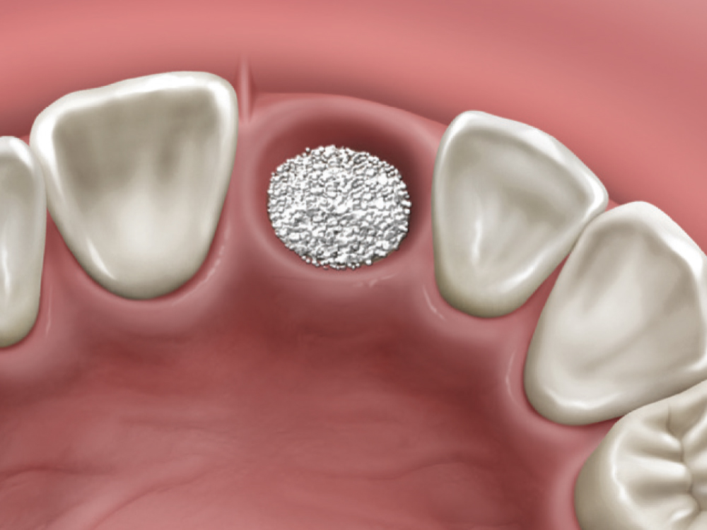 Socket Grafting: When to Graft and What to Use