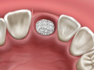 Socket Grafting: When to Graft and What to Use